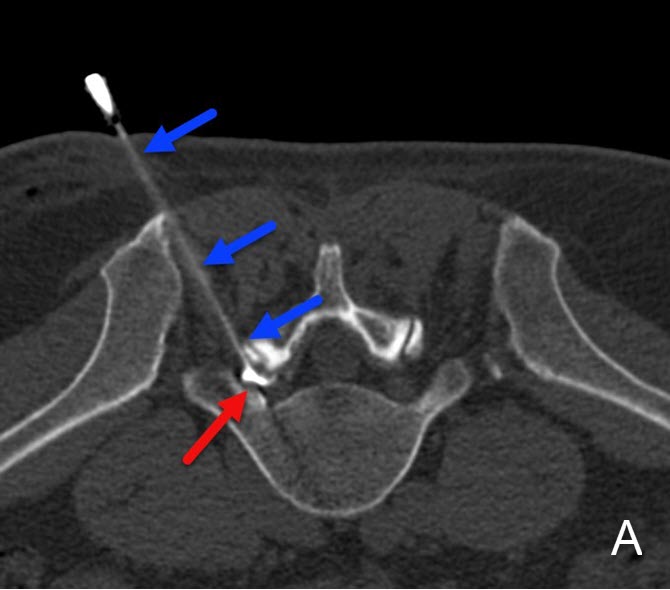Infiltration ciblée des racines nerveuses - Universitätsinstitut für Diagnostische und ...